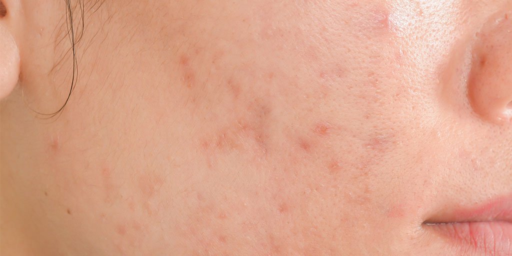 Red Acne Scars