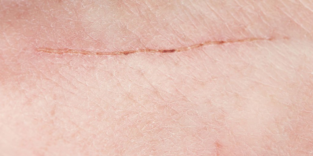 Scar from stitches - How to prevent it : causes, treatments